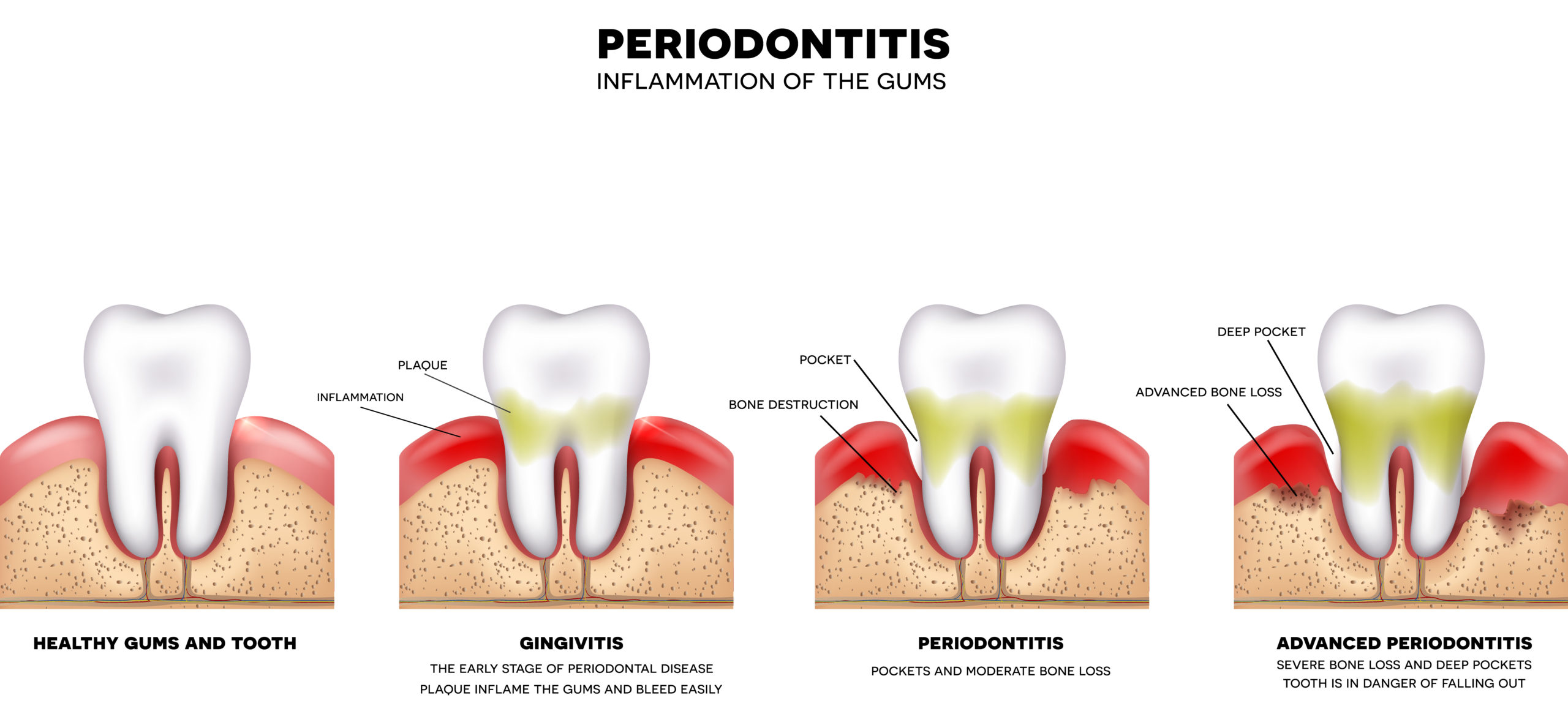 What are the Signs and Symptoms of Periodontal Disease? - Dentistry ...